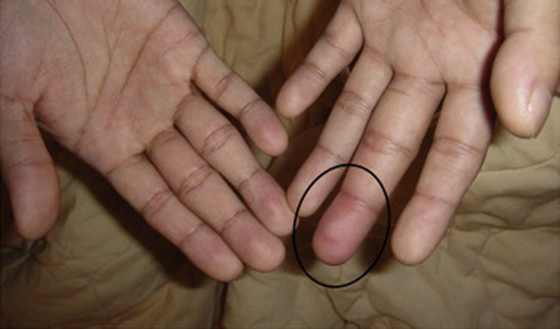 Ha un nodulo bluastro sulla mano, la diagnosi è choc | Caffeina Magazine