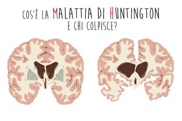 Malattia di Huntington: i sintomi e chi colpisce | Caffeina Magazine