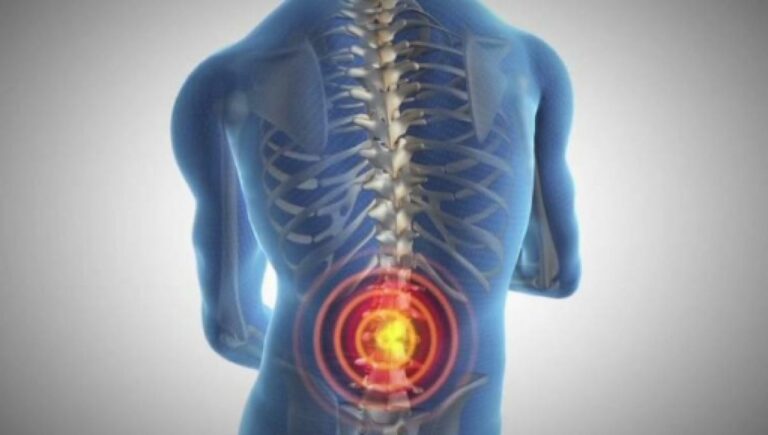Spondilite anchilosante, senza diagnosi precoce danni irreversibili ...