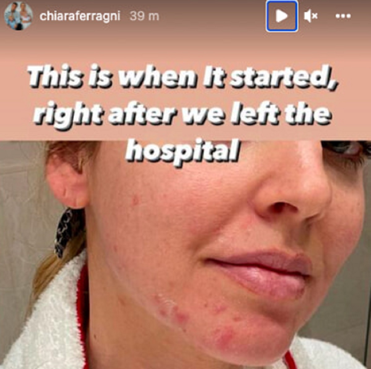 Chiara Ferragni, la foto dello sfogo da stress sul viso: "Guardate..."