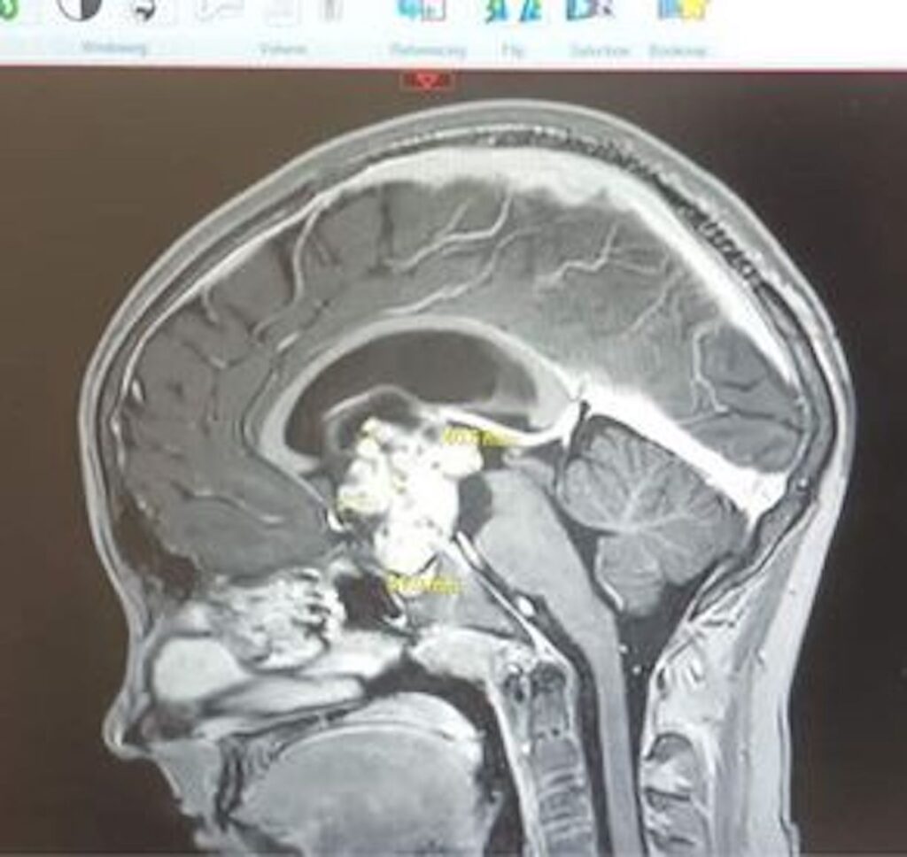 “Mamma ho mal di testa” e scopre di avere il cancro